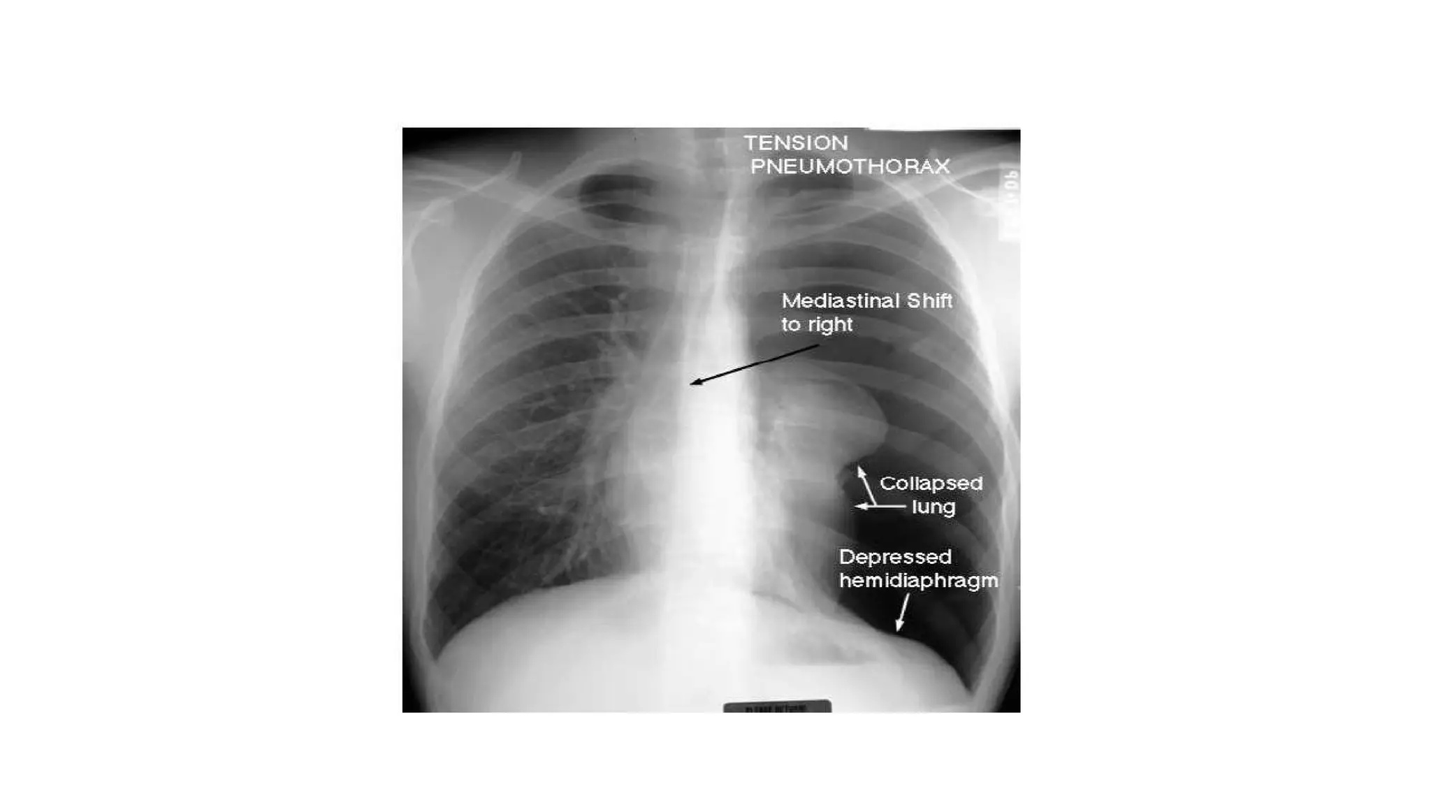 Trauma pada dada blunt chest trauma.pptx | First Aid | Injuries