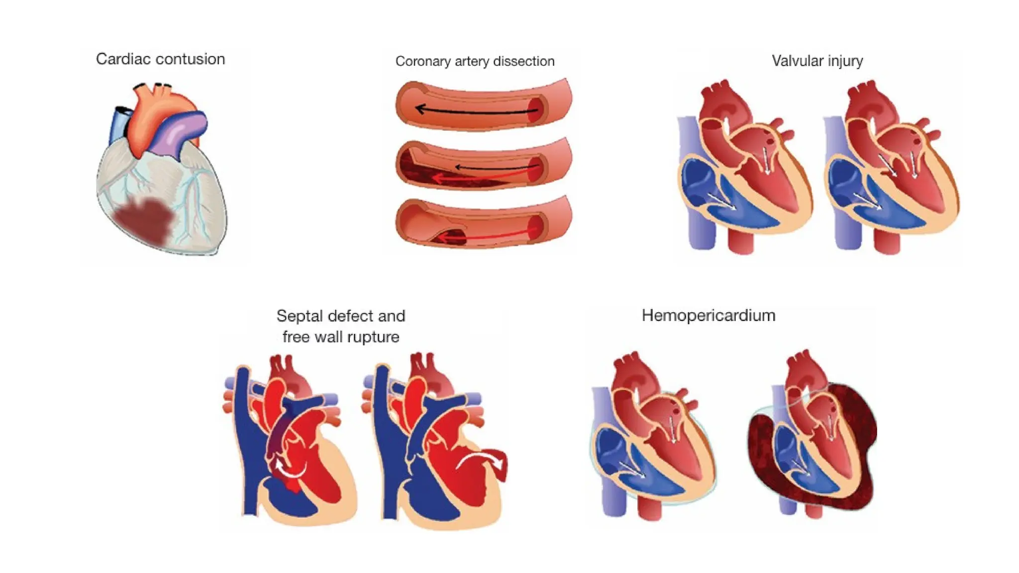 Trauma pada dada blunt chest trauma.pptx | First Aid | Injuries