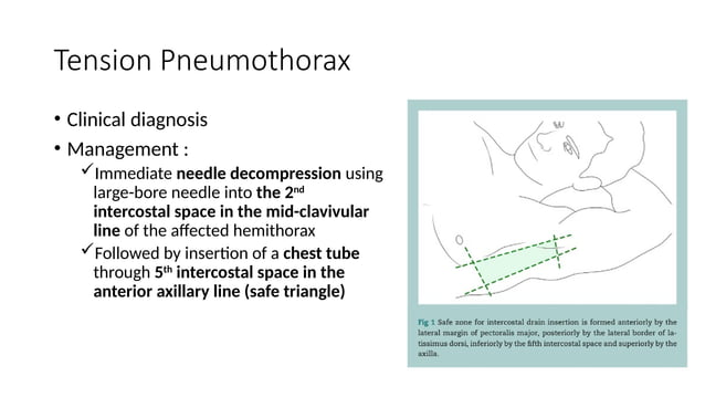 Trauma pada dada blunt chest trauma.pptx