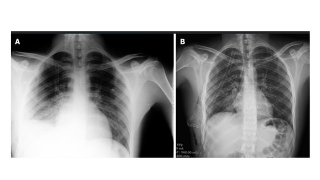 Trauma pada dada blunt chest trauma.pptx