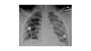 Trauma pada dada blunt chest trauma.pptx | First Aid | Injuries