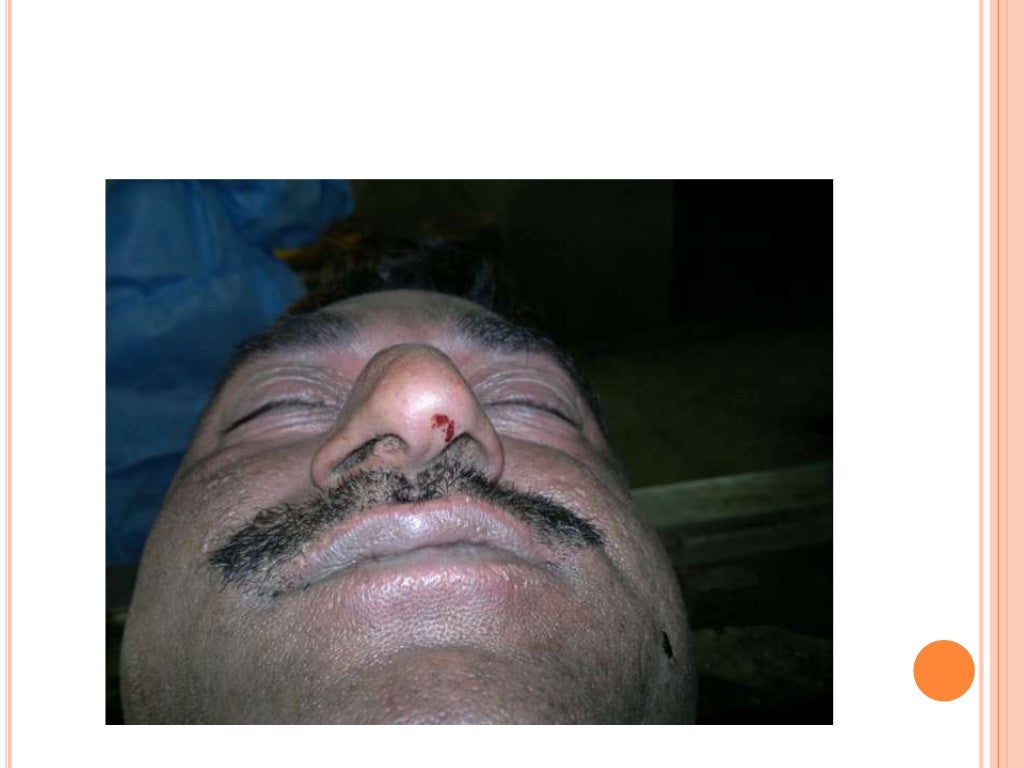 Blunt force injuries