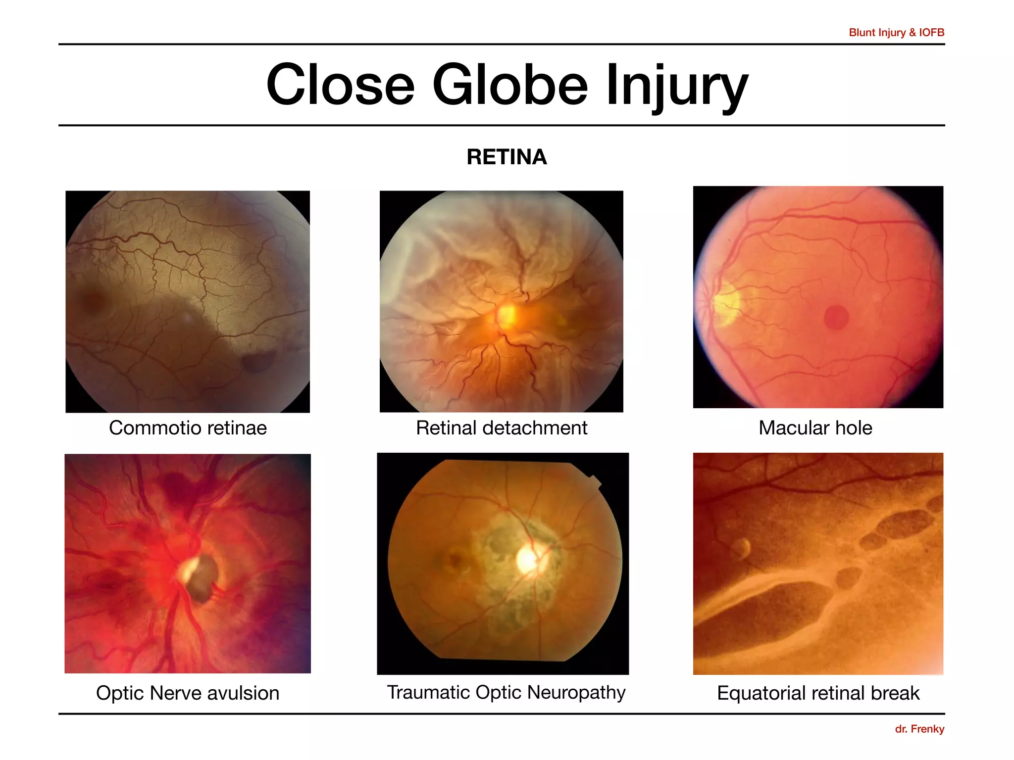 Ocular Blunt injury | PDF
