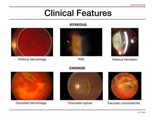 Ocular Blunt injury | PDF