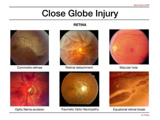 Ocular Blunt injury | PDF