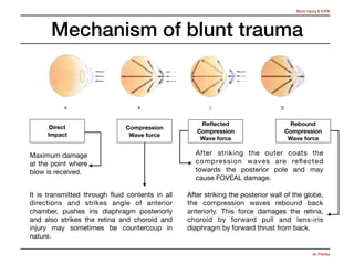 Ocular Blunt injury | PDF