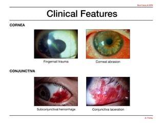 Ocular Blunt injury | PDF