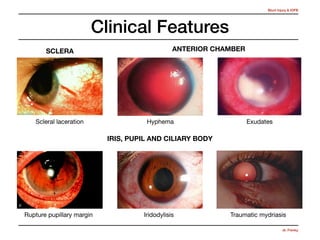 Ocular Blunt injury | PDF