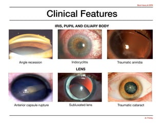 Ocular Blunt injury | PDF