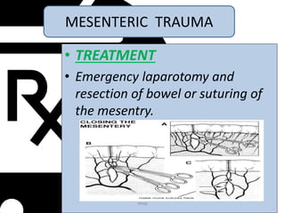 Blunt injury abdomen(renal trauma&mesenteric trauma) | PPTX