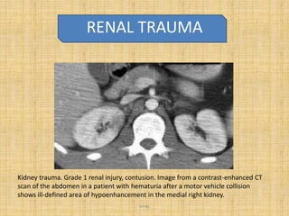 Blunt injury abdomen(renal trauma&mesenteric trauma) | PPTX