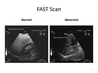 Blunt Thoraco-Abdominal Trauma.pptx