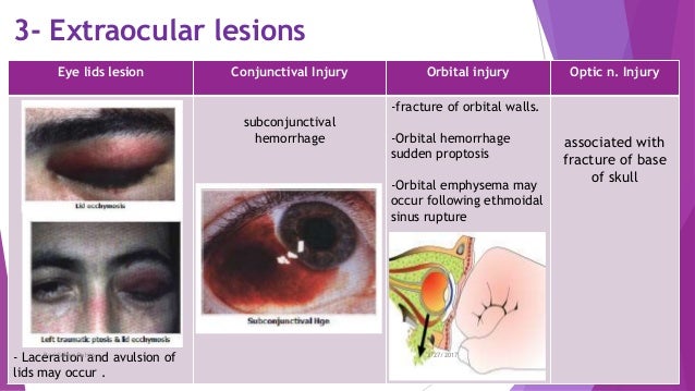 Blunt trauma of the eye