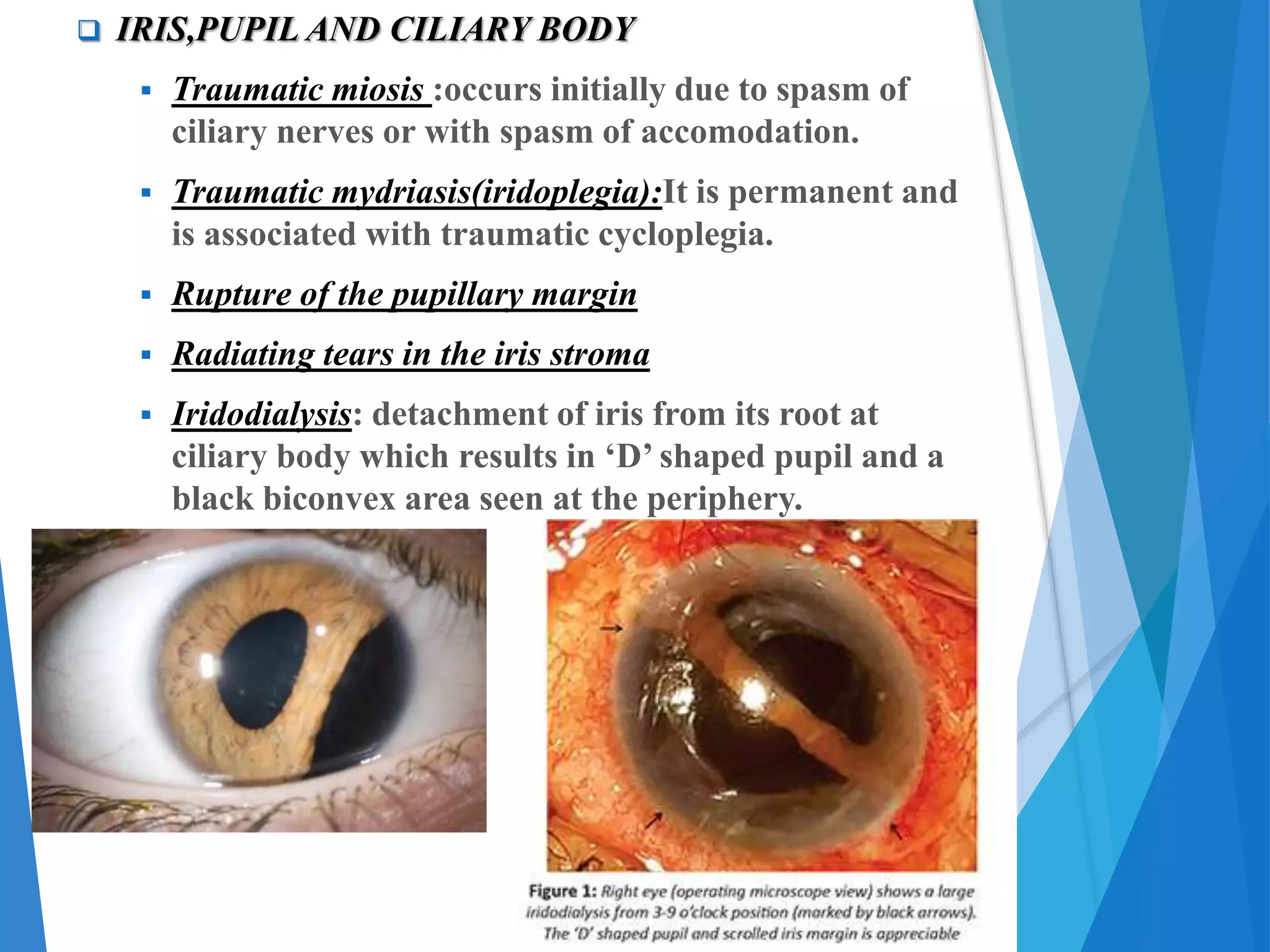 Blunt trauma of eye | PPTX