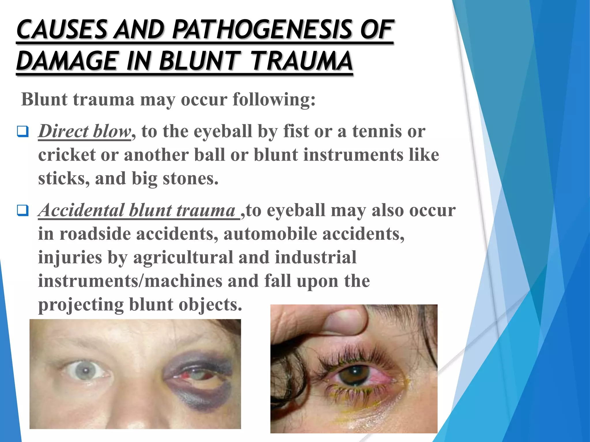 Blunt trauma of eye | PPTX