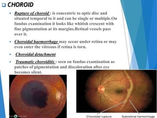 Blunt trauma of eye | PPTX