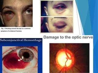 Blunt trauma of eye | PPTX