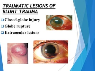 Blunt trauma of eye | PPTX