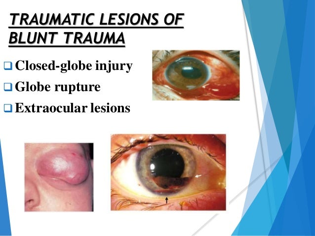 Blunt trauma of eye