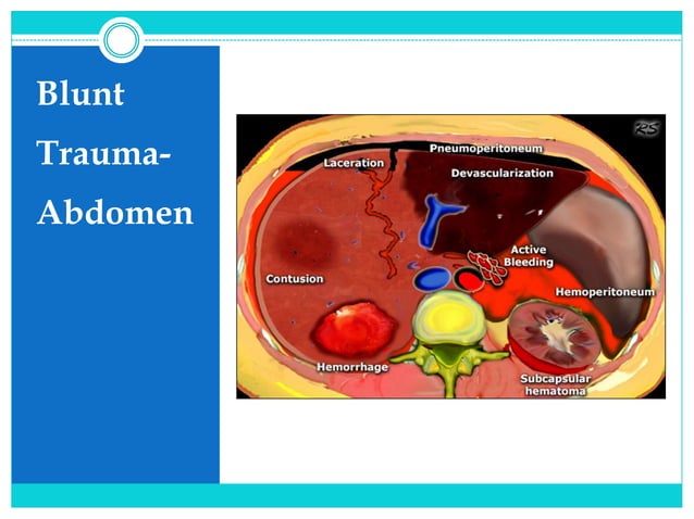Blunt trauma abdomen | PPT