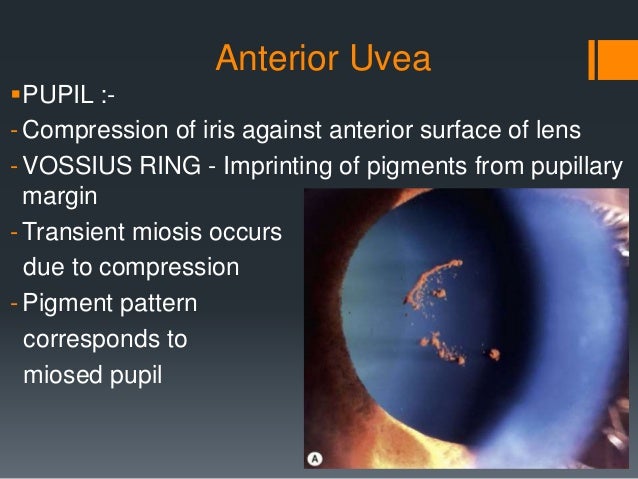 Blunt trauma & blow out fracture