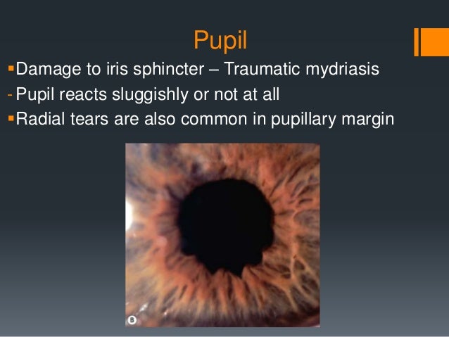Blunt trauma & blow out fracture