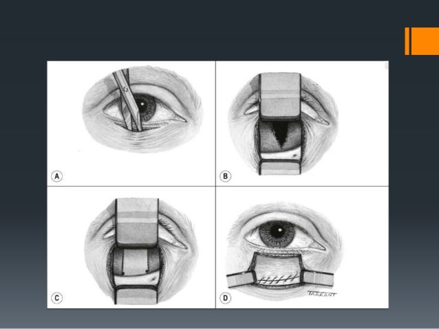 Blunt trauma & blow out fracture