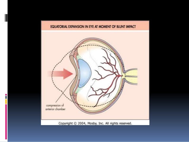 Blunt Ocular Trauma