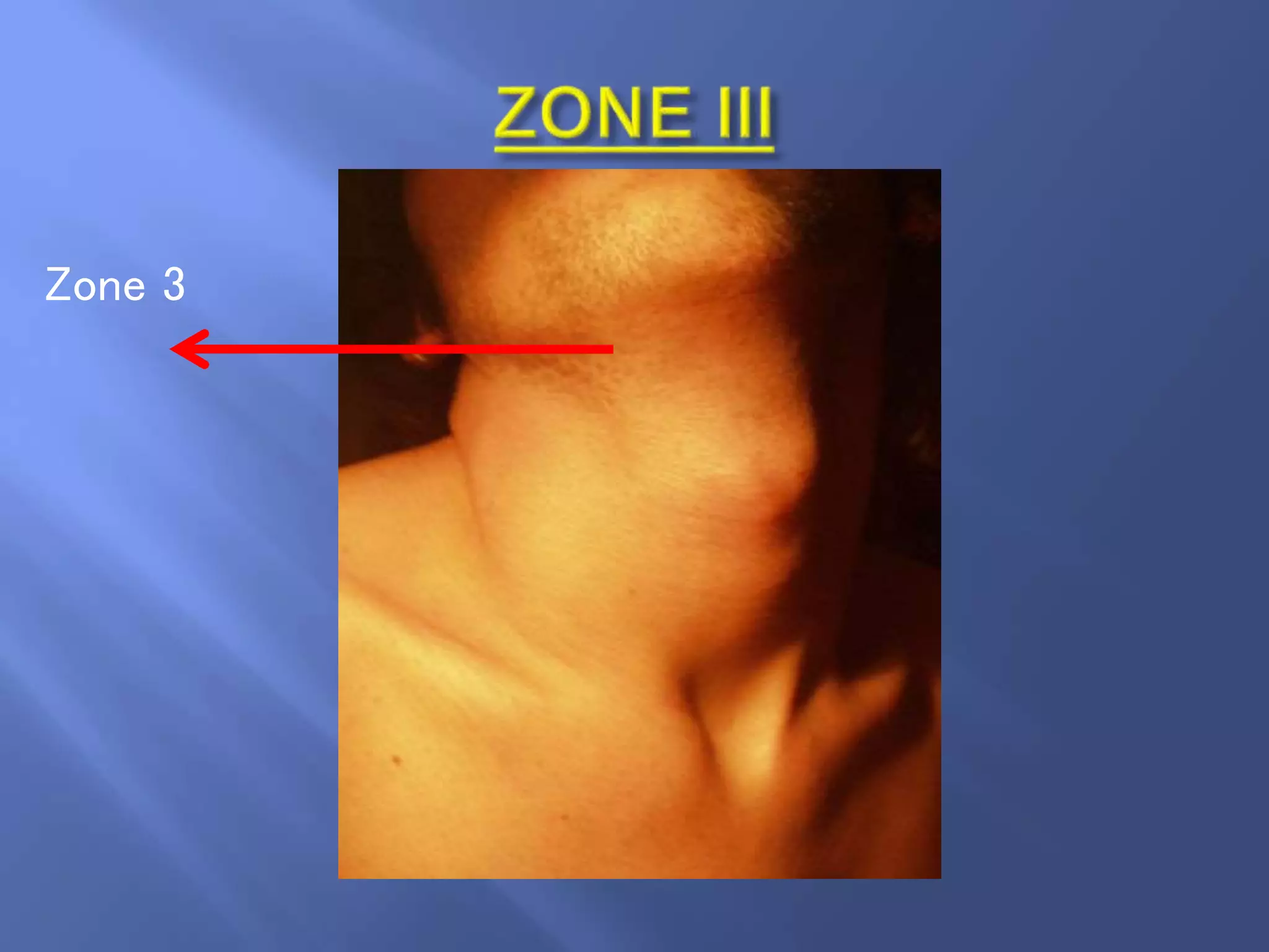 Blunt trauma neck | PPT