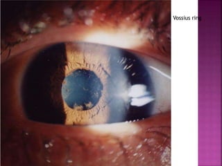 Blunt trauma to eye | PPTX