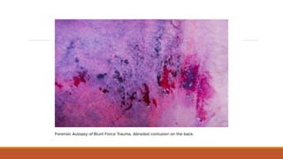 blunt trauma wounds-2.pptx