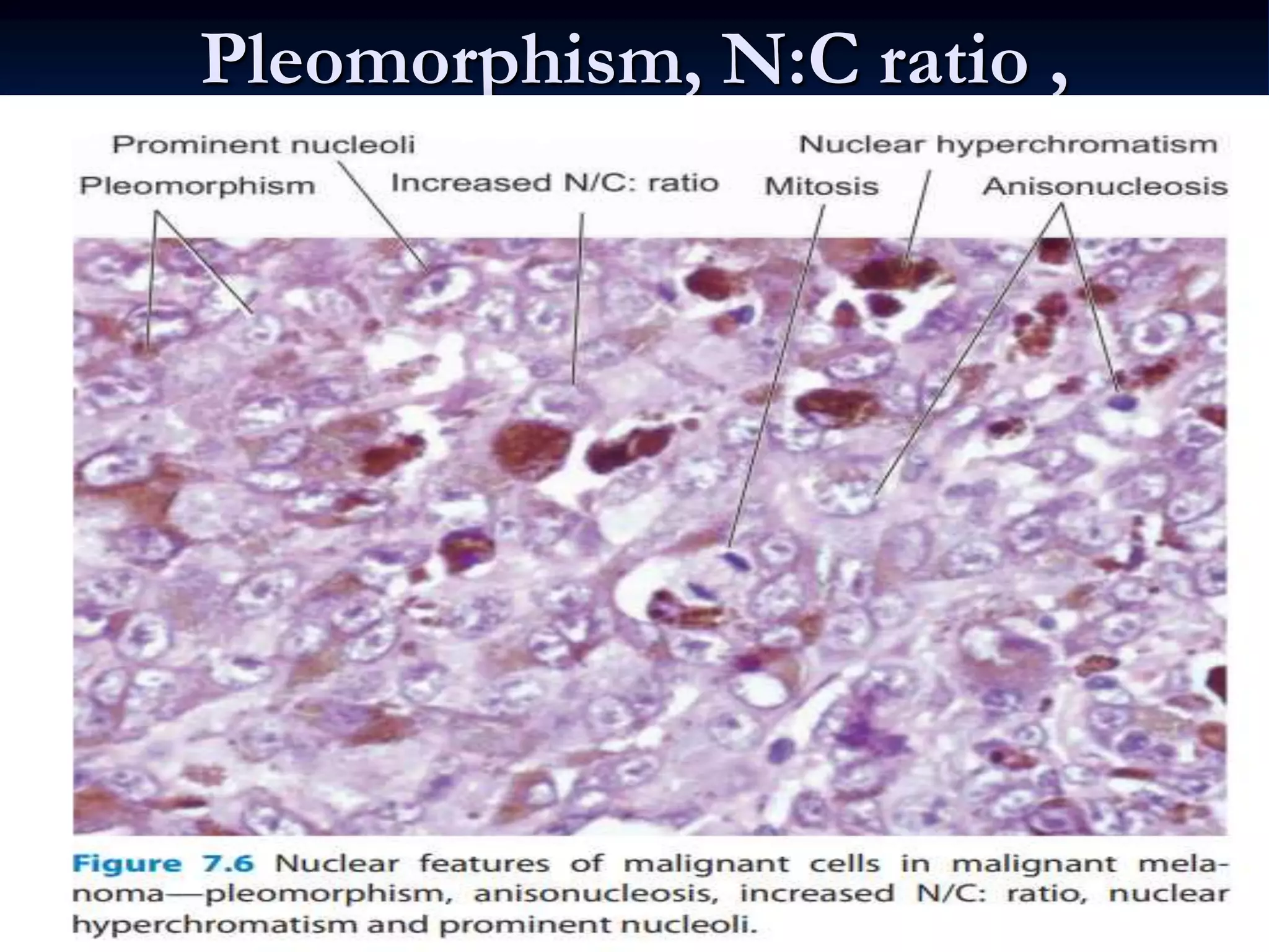 NEOPLASIA: Clinical Features of Tumors, Grading and Staging ...