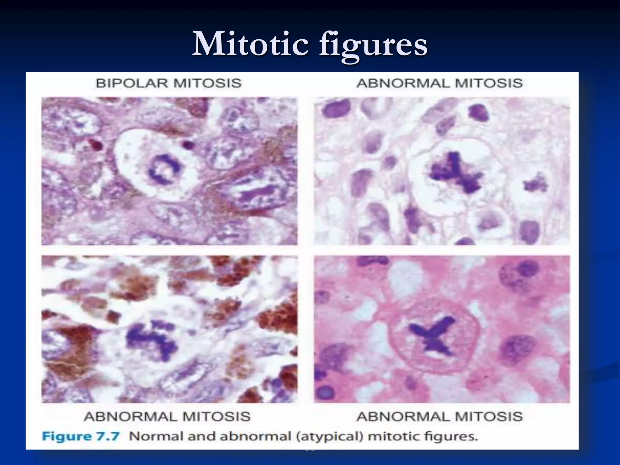 NEOPLASIA: Clinical Features of Tumors, Grading and Staging ...