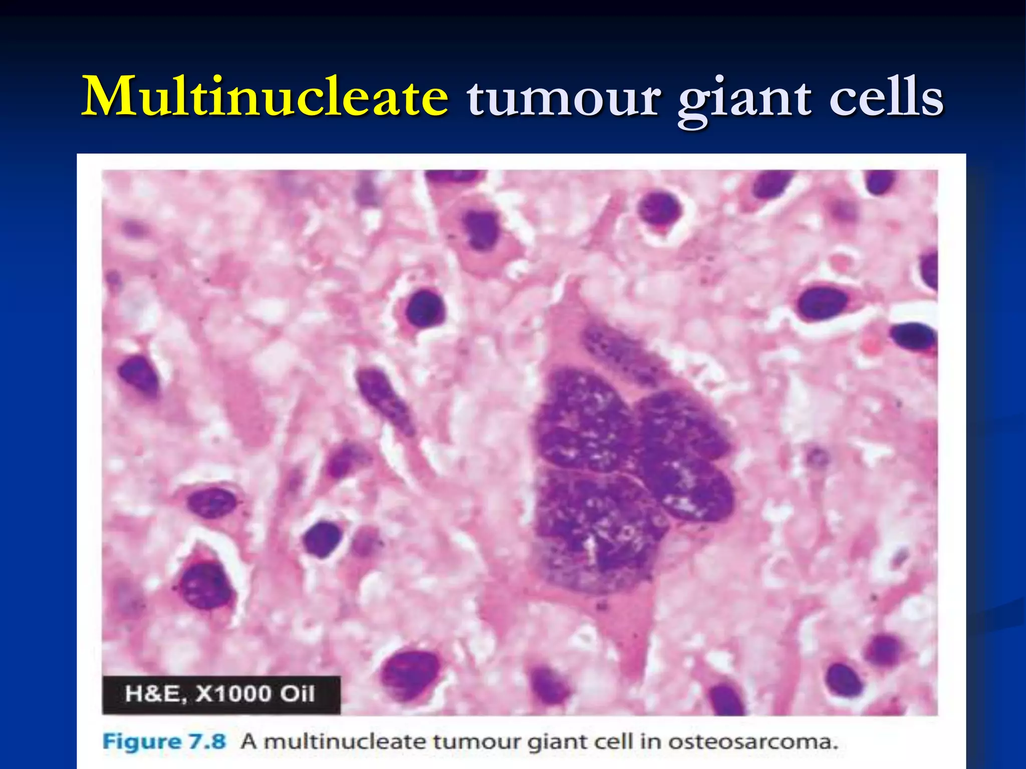 NEOPLASIA: Clinical Features of Tumors, Grading and Staging ...