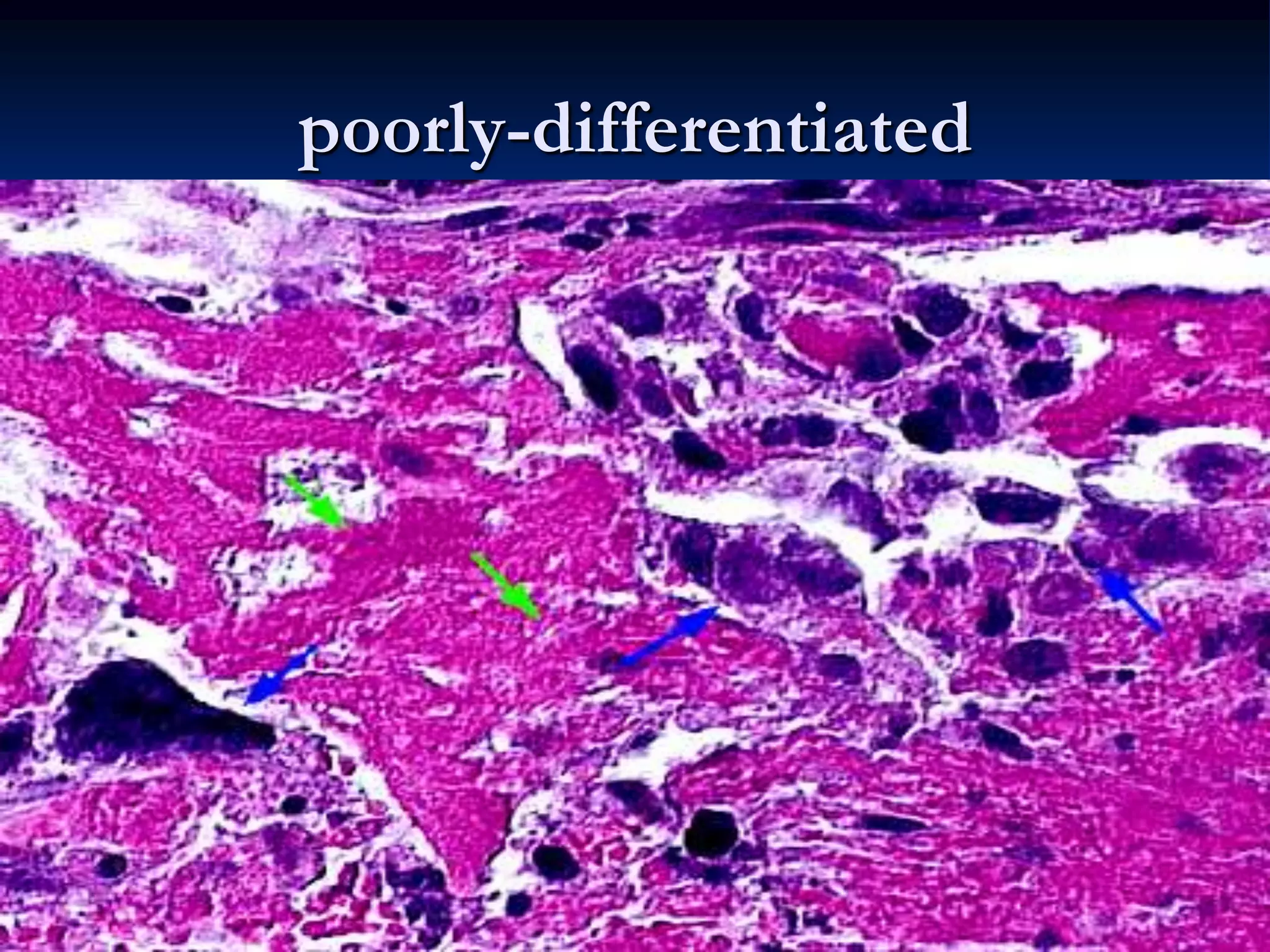 NEOPLASIA: Clinical Features of Tumors, Grading and Staging ...