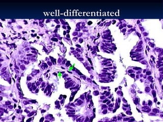 NEOPLASIA: Grading and Staging & Laboratory Diagnosis of Cancer | PPT