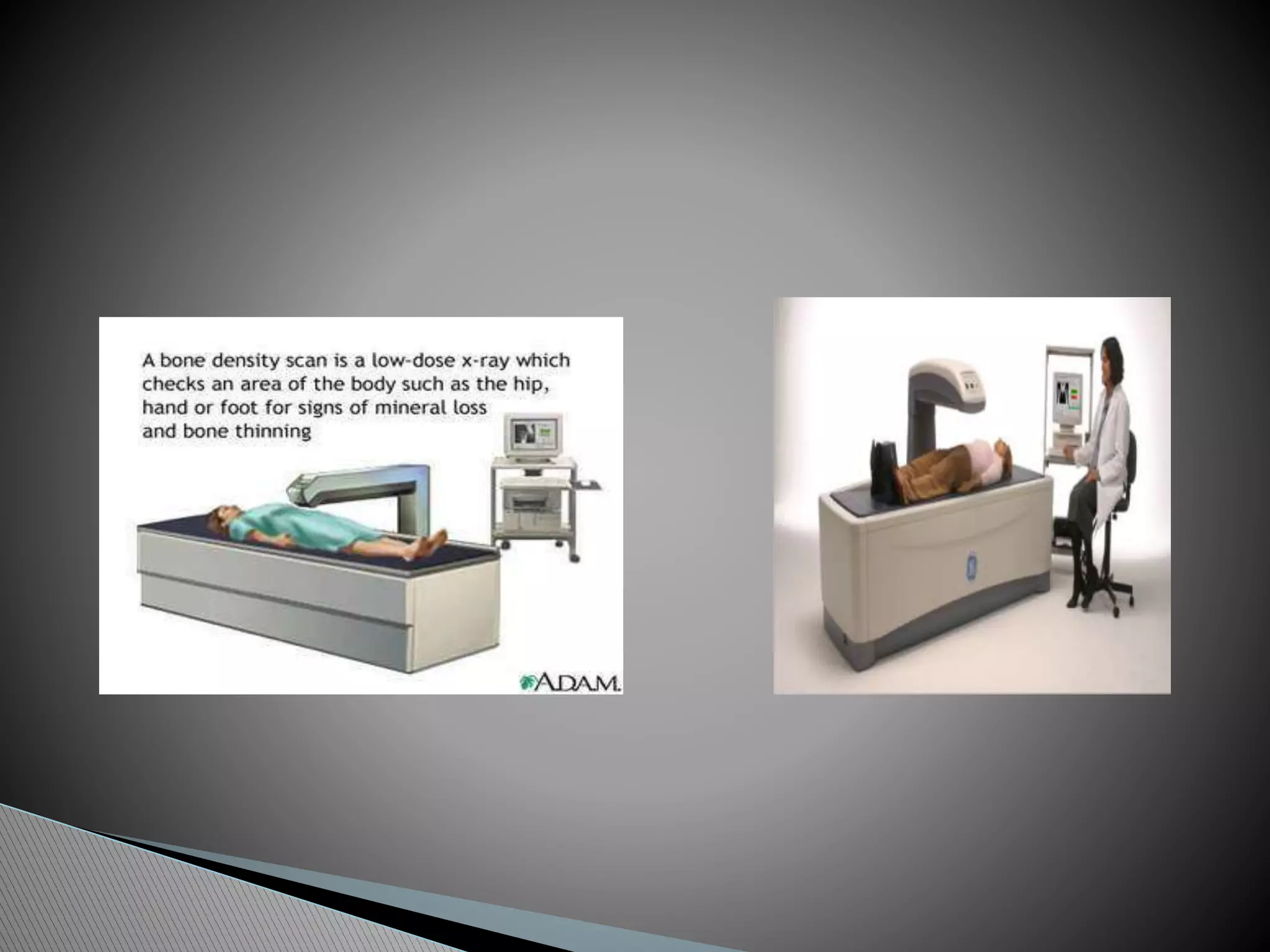 Bone marrow density (BMD) | PPTX