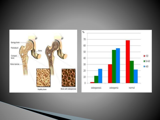 Bone marrow density (BMD) | PPTX