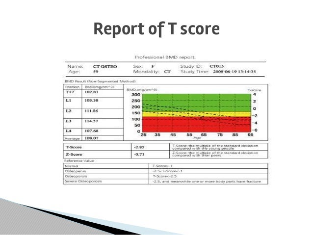Bone marrow density (BMD)
