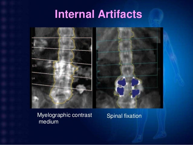 Bone Mineral Density