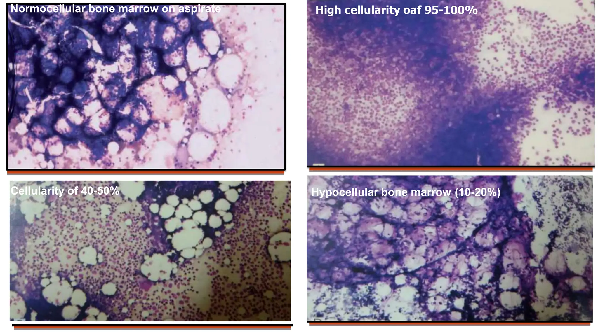 Bone Marrow evaluation EVALUATION (PBS+BMA).pptx