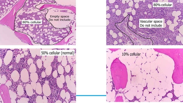 Bone Marrow evaluation EVALUATION (PBS+BMA).pptx