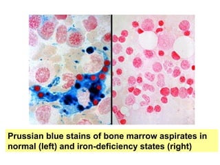 Prussian Blue Stain Bone Marrow