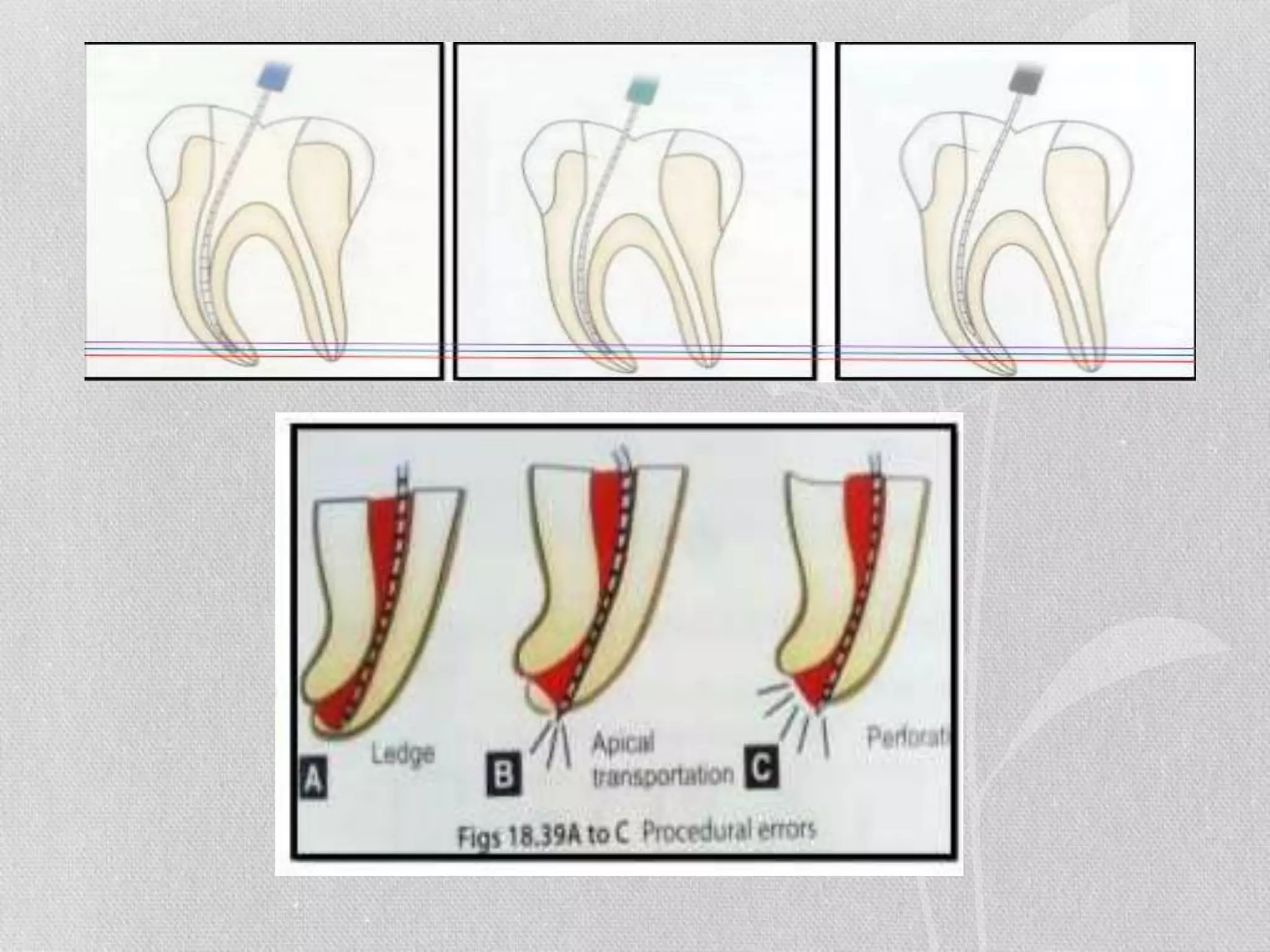 Biomechanical preparation in endodontics | PPTX