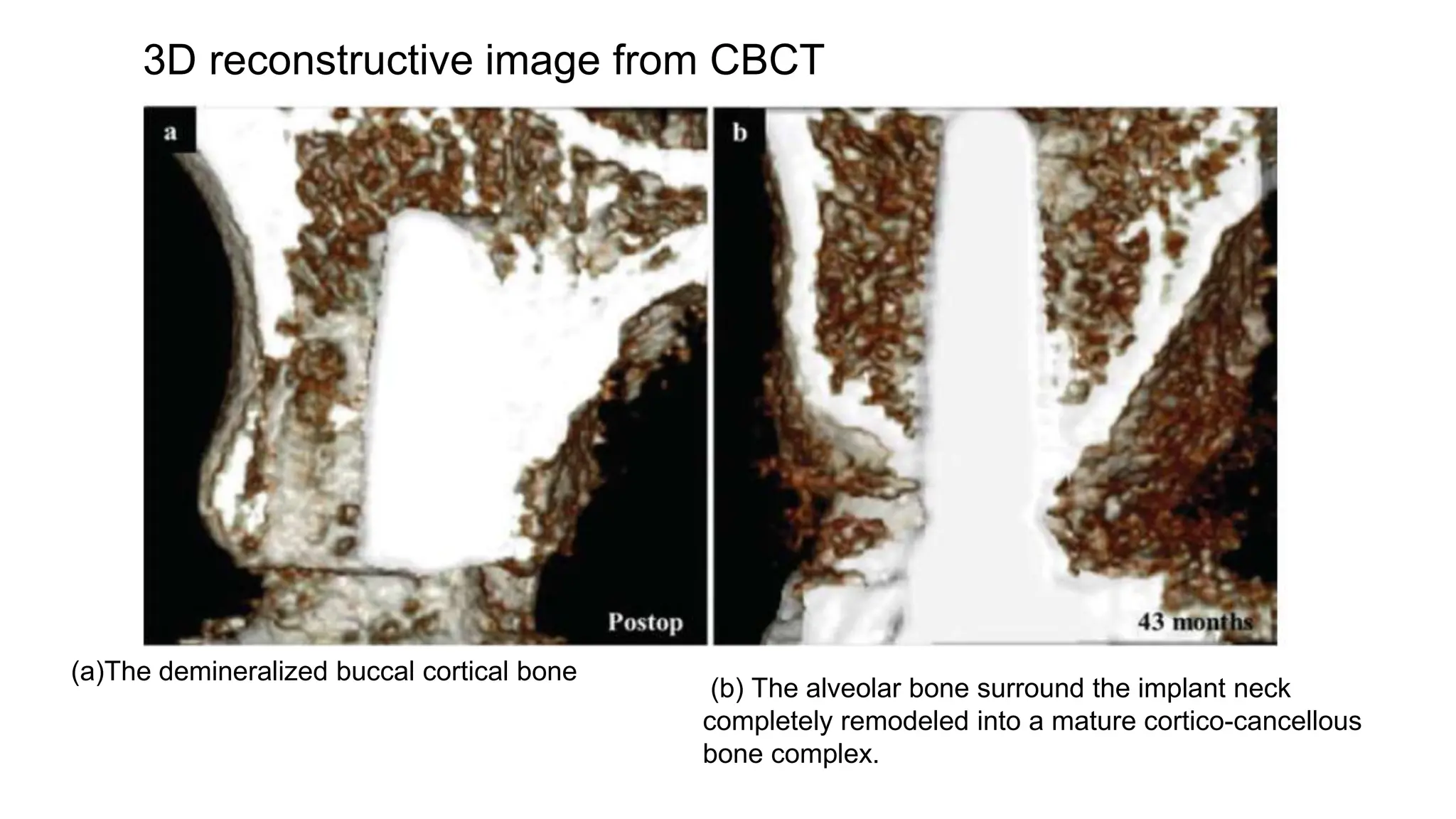bone morphogenetic protein in periodontics | PPTX