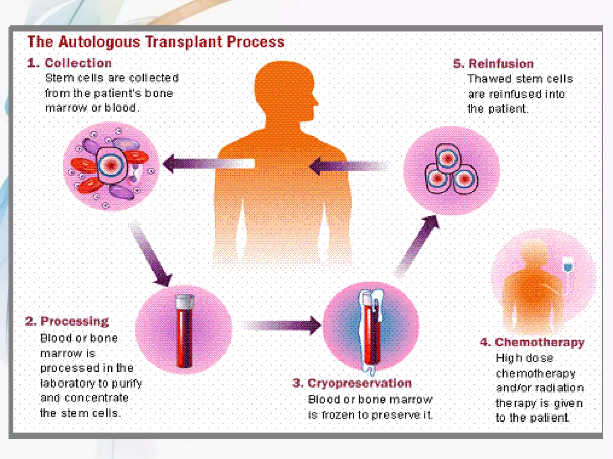 Bone Marrow Transplantation | PPTX