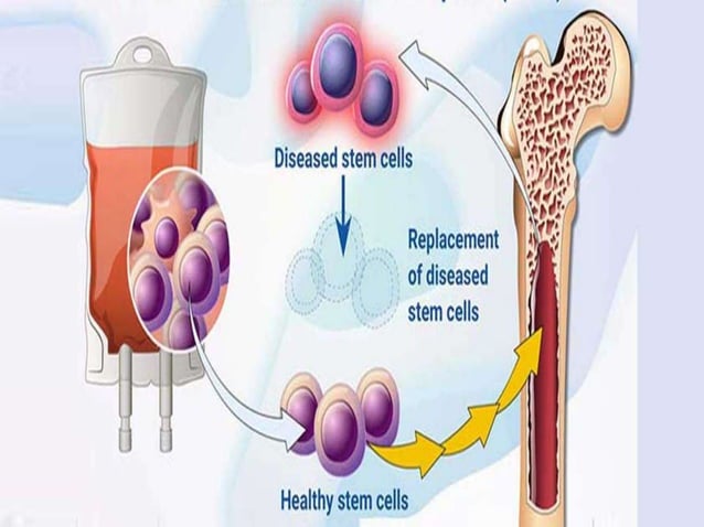 Bone Marrow Transplantation | PPTX