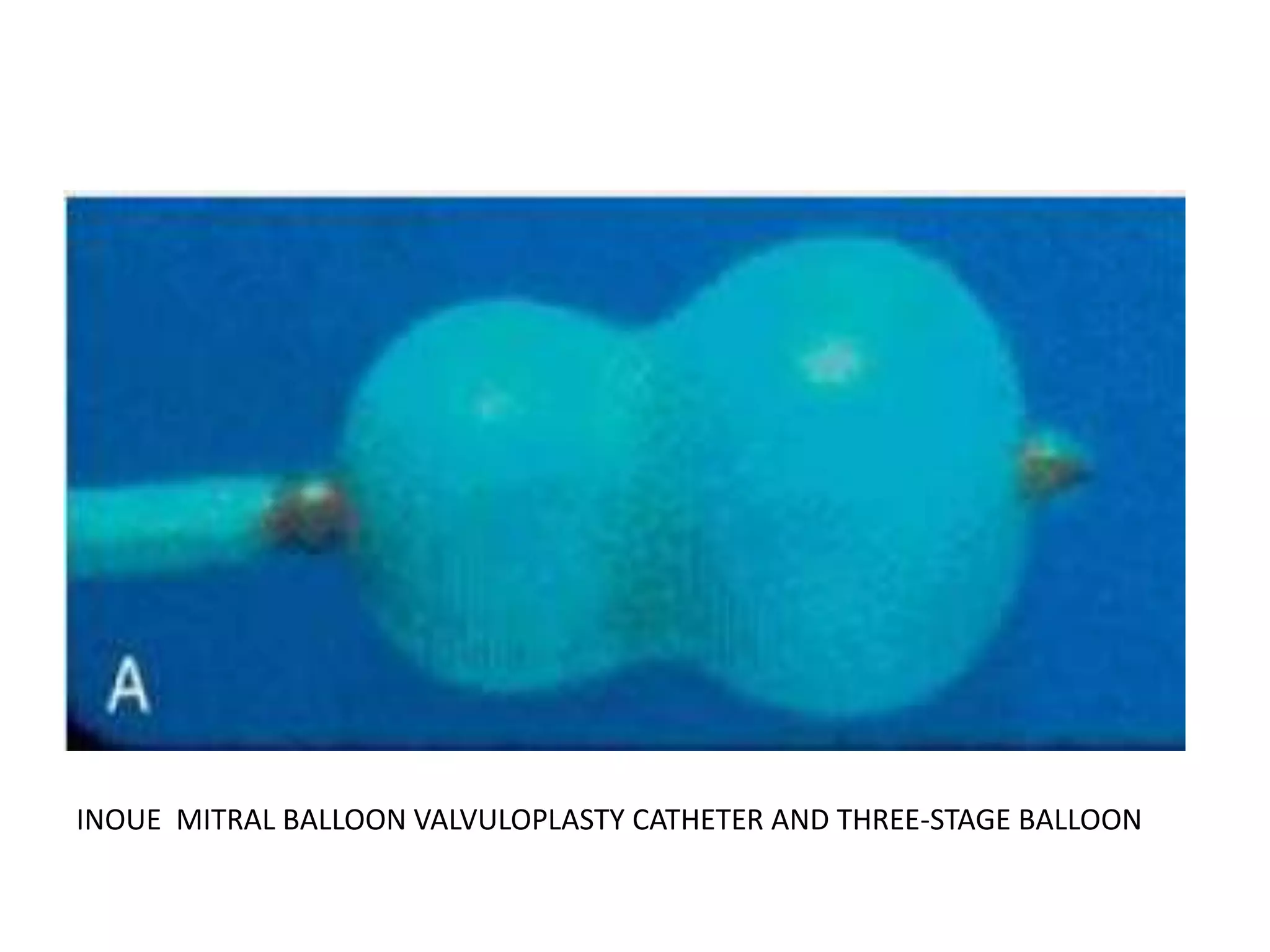 BMV,PTMC,BALLOON MITRAL VALVOTOMY, BAL, VIRBHAN BALAI, DR VIRBHAN | PPTX