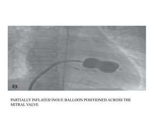 BMV,PTMC,BALLOON MITRAL VALVOTOMY, BAL, VIRBHAN BALAI, DR VIRBHAN | PPTX