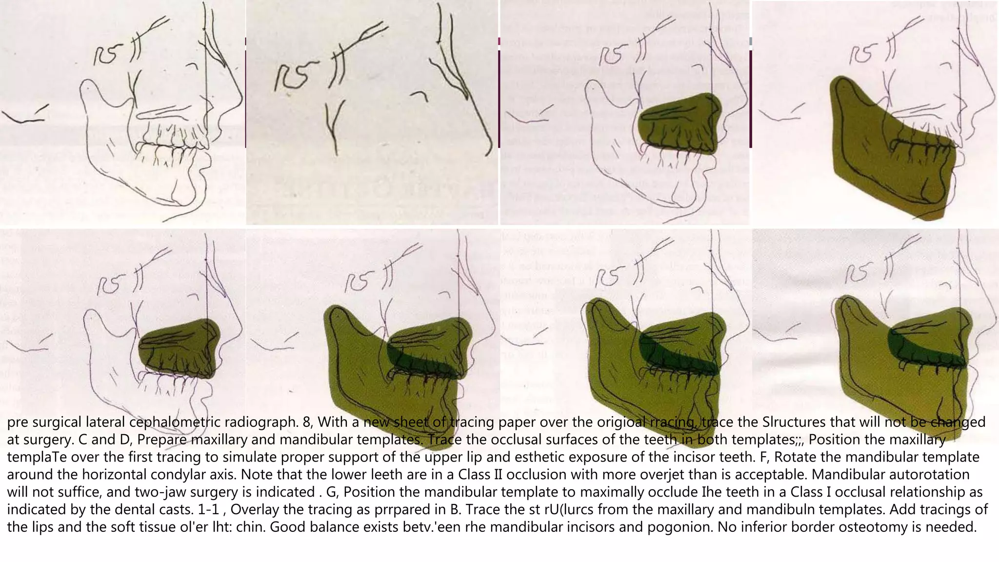 bimaxillary surgery.pptx